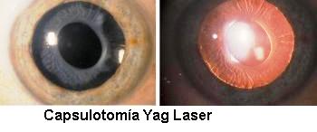 Capsulotomía láser posterior (limpieza de lente intraocular ...